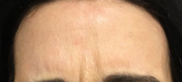 BOTOX Michigan | Top Detroit BOTOX Injections